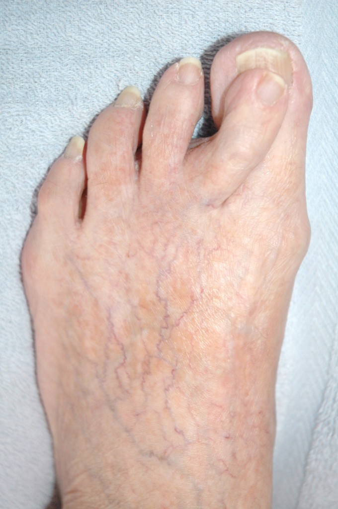 Morton's Toe| What is it, What Causes it, How to Treat it