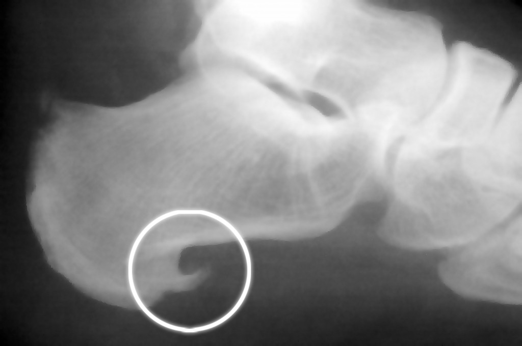 Morton's Toe| What is it, What Causes it, How to Treat it