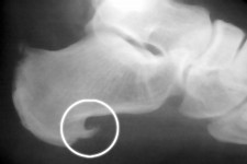 Morton's Toe| What is it, What Causes it, How to Treat it