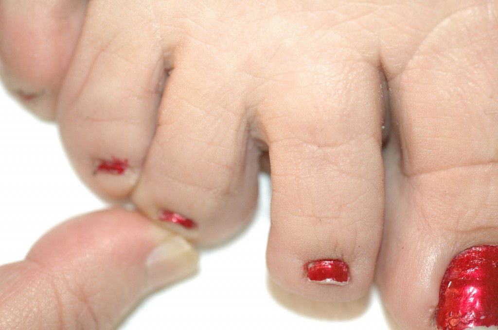 Morton's Toe| Expert explains what is it, and what causes it